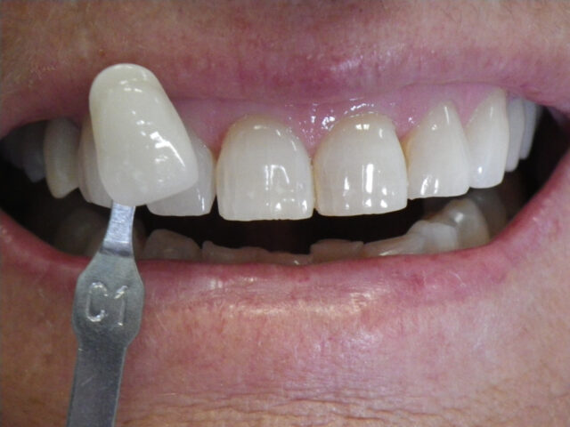 Professional Opalescence Teeth Whitening in San Luis Obispo